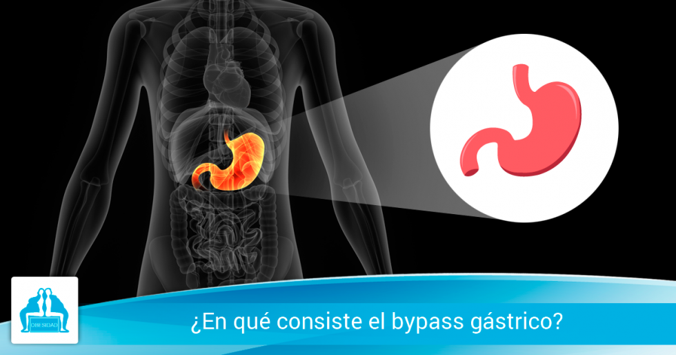 ¿En qué consiste el bypass gástrico? | Dr. Ricardo Javier Salinas Garza